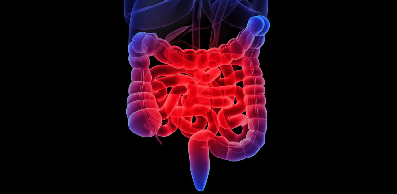 IBD là bệnh gì? Nguyên nhân và cách phòng ngừa | TCI Hospital