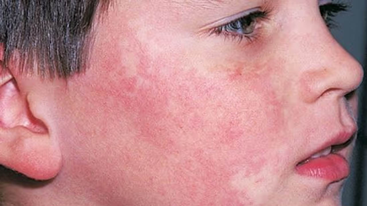 Bệnh lupus ban đỏ có chết không? Liệu sống được bao nhiêu năm?
