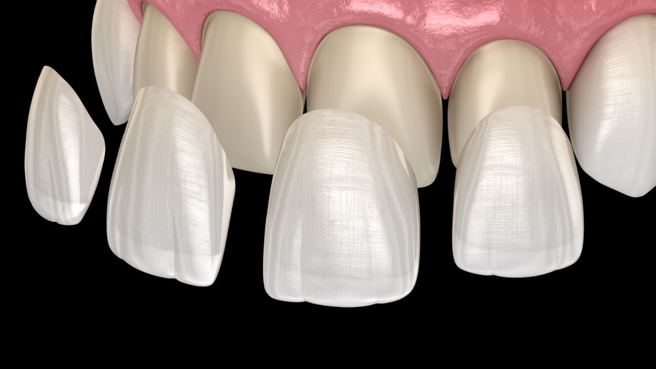 Dán sứ veneer có bền không? Được bao lâu?